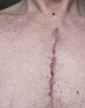 What to Expect from Coronary Artery Bypass Grafting (CABG) - Heart Advisor
