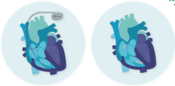 Wireless Dual-Chamber Pacemakers a Huge Advance - Heart Advisor